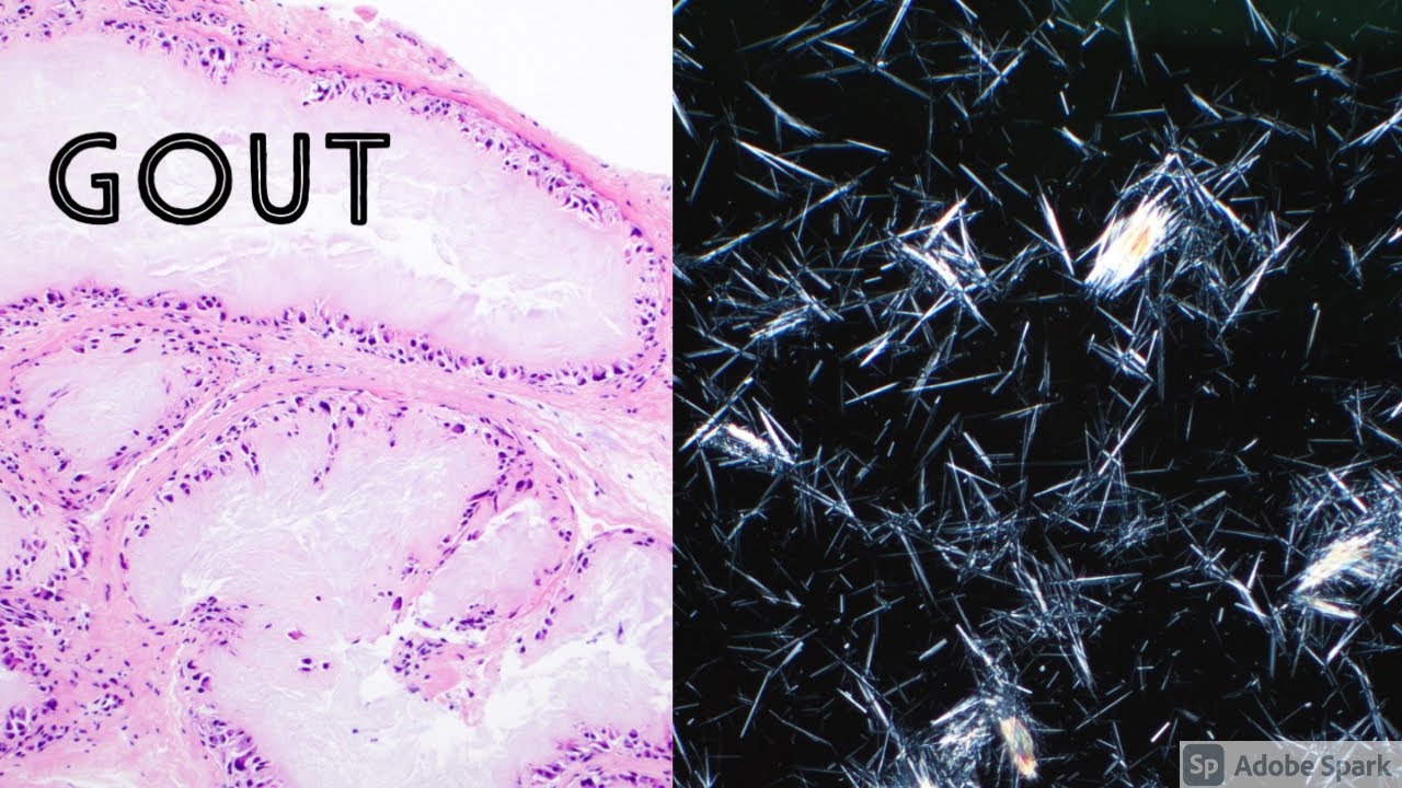 GOUT Under the Microscope: Brilliant Polarizable Birefringent Monosodium Urate Crystals