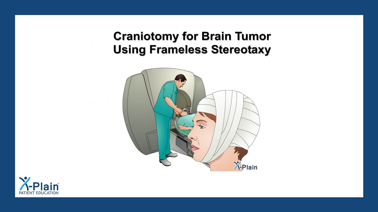 Craniotomy for Brain Tumor Using Frameless Stereotaxy