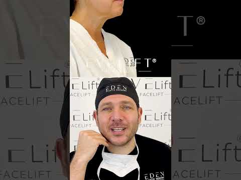 EVE Lift™ Patient Michelle Before and Just 4 Days After | Dr. Ali Charafeddine, MD