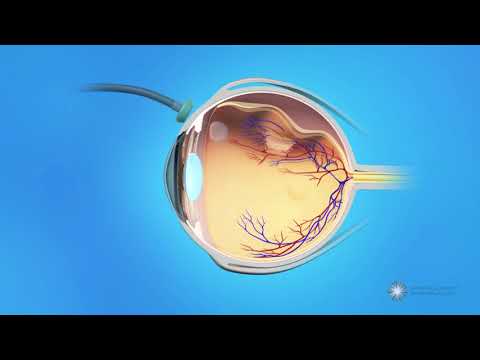 Vitrectomy Surgery for Detached Retina