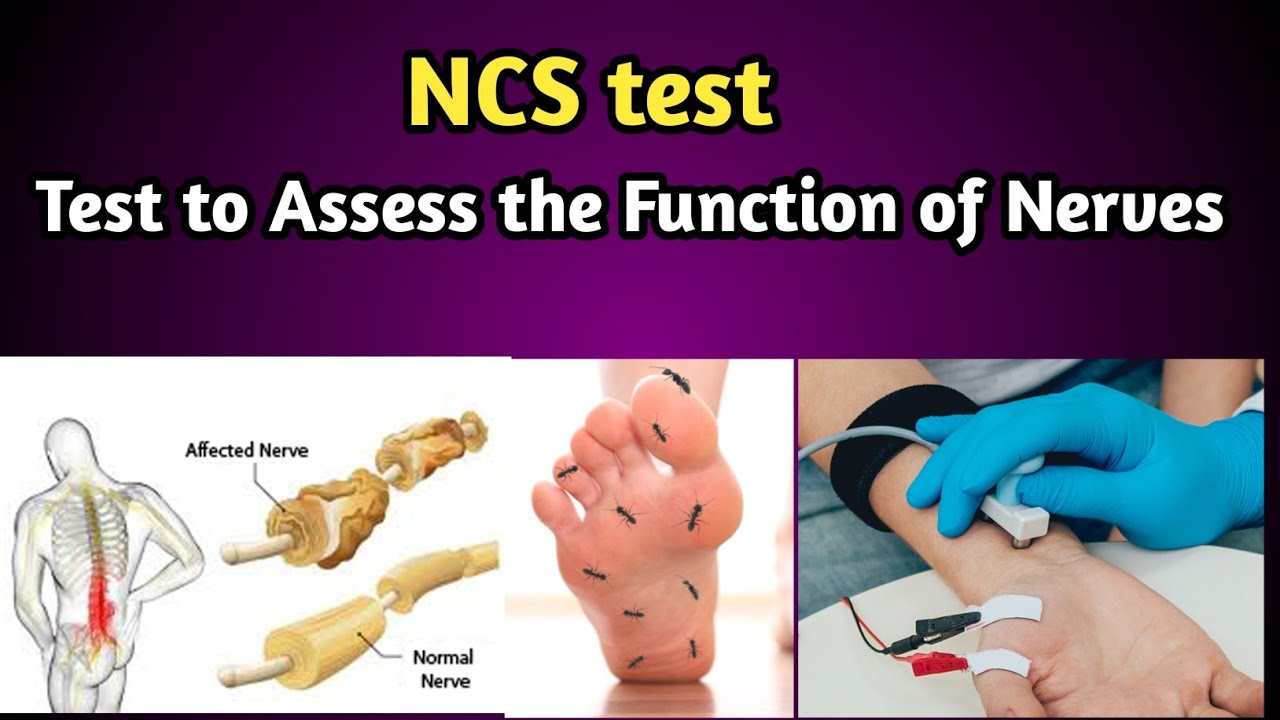 NCS Test ( Nerve Conduction Study) Procedure.