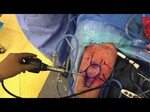 Arthroscopic Lysis of Adhesions and Anterior Interval Release With Manipulation Under Anesthesia...