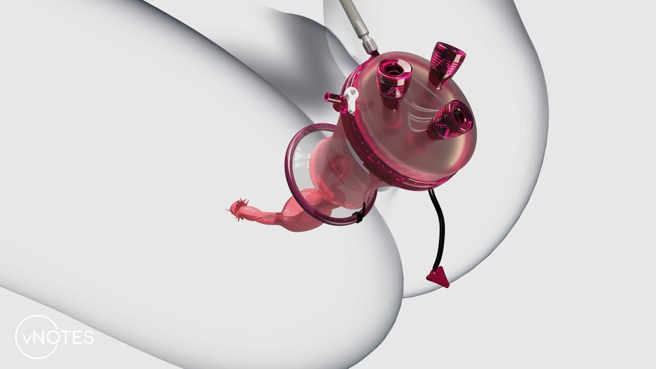 vNOTES Hysterectomy Animation | Featuring the GelPOINT V-Path Transvaginal Access Platform