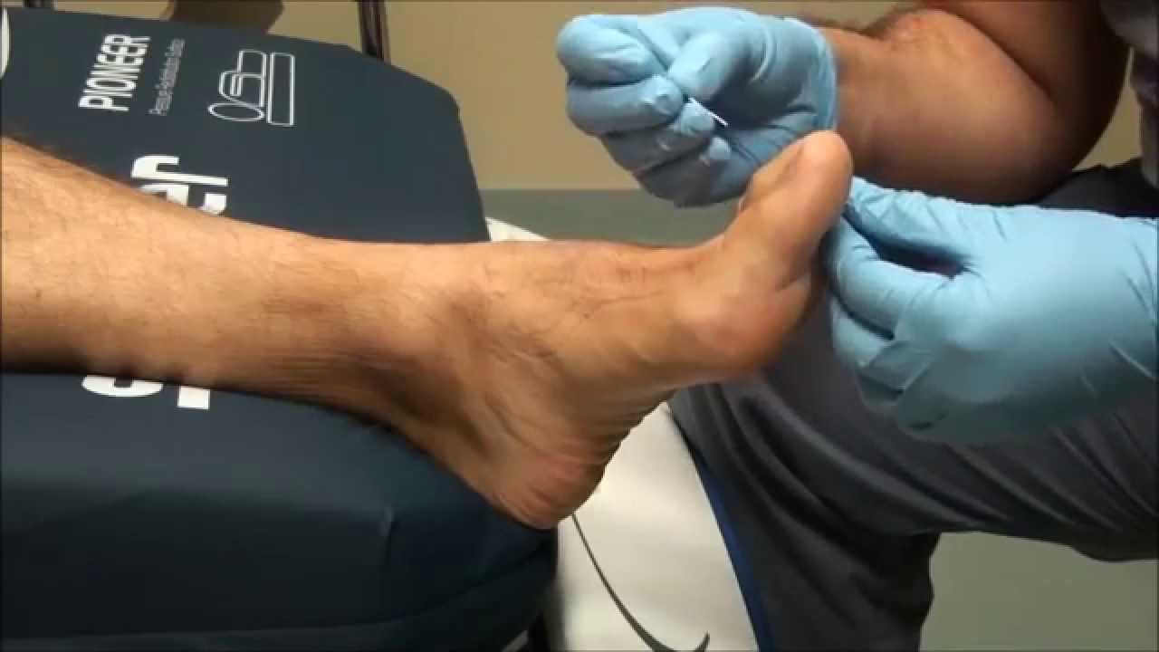 Neurologic Examination of the Foot: Pin Prick Testing