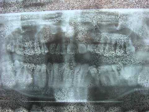 Direct Reimplantation.wmv