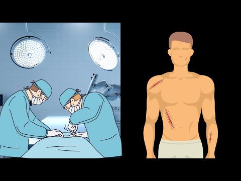 The impact of Scar Tissue after Surgery
