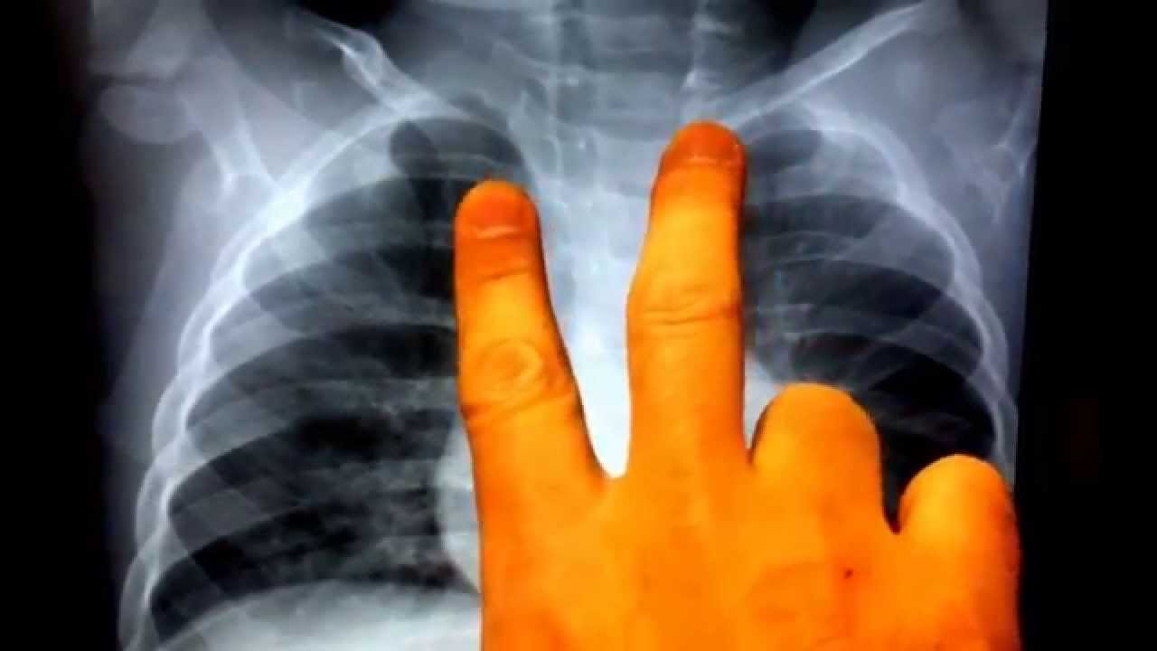 Peri bronchial cuffing - RSV