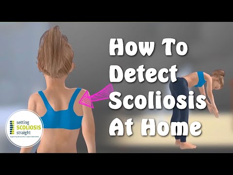 How to Detect Scoliosis at Home | Explained Under 1 minute