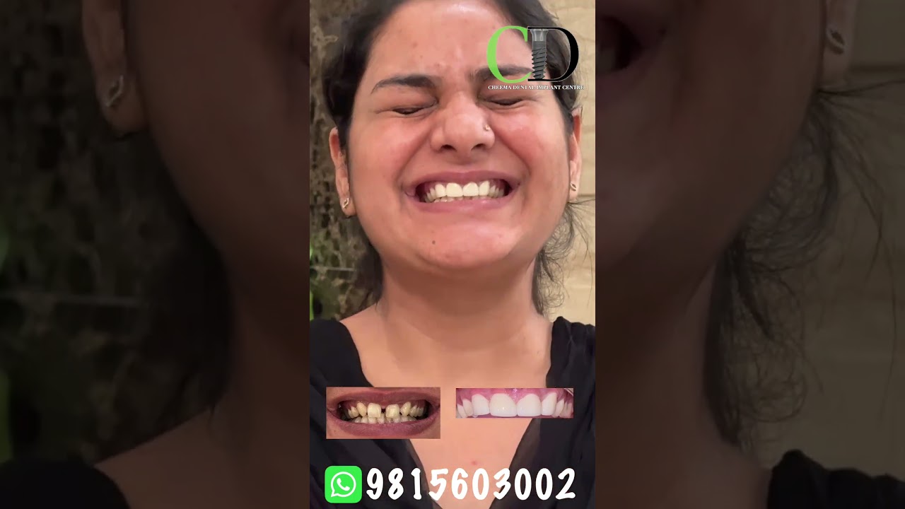 Teeth Gap Close with Dental Porcelain Veneers | Jalandhar Punjab #dentist #dentistry #smile #veneers