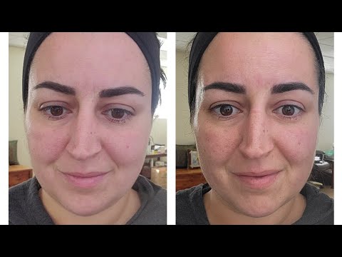 Cryo T-Shock self cryofacial treatment