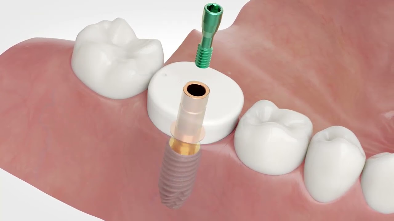 Socket Sealing Technique | Animated Step-by-Step Guide | Roott Implants
