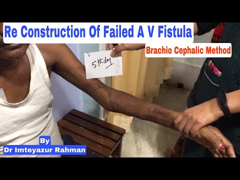 A V Fistula reconstruction, kidney failure, Dialysis, vascular surgery