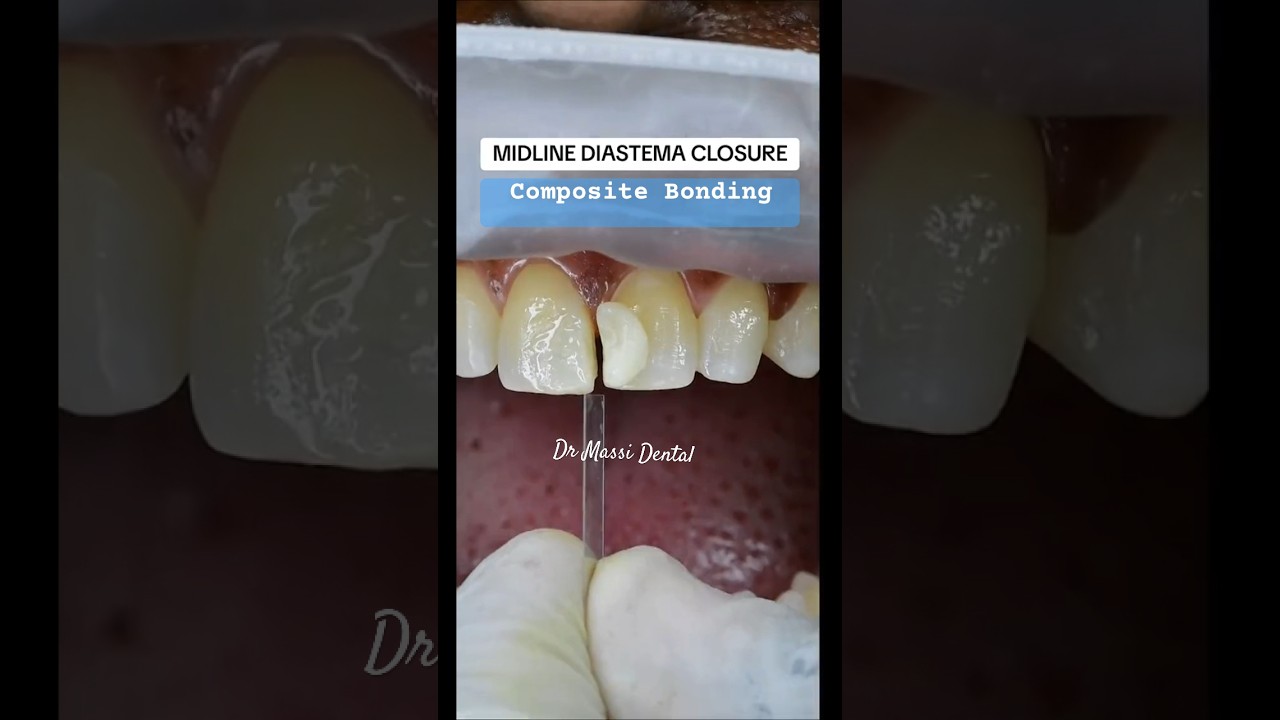 Midline Closure, Composite Bonding