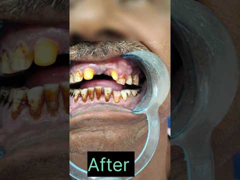 3 Unit Zreconia crown #dentalclinic #dentalcare