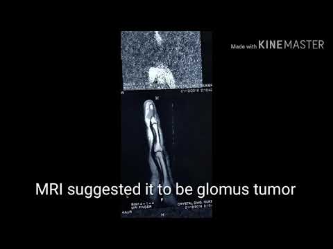 A Painful Glomus Tumor on the Pulp of the Distal Phalanx