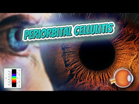 Periorbital cellulitis - Your EYEBALLS - EYNTK 👁️👁️💉😳💊🔊💯✅