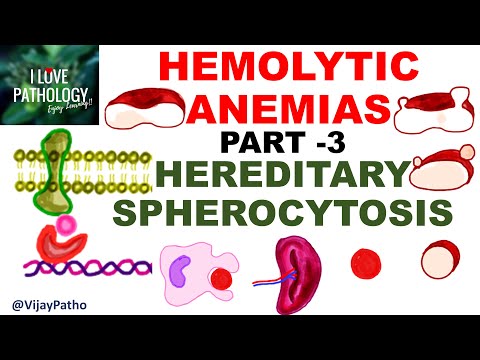 Hemolytic Anemias- Part 3: HEREDITARY SPHEROCYTOSIS