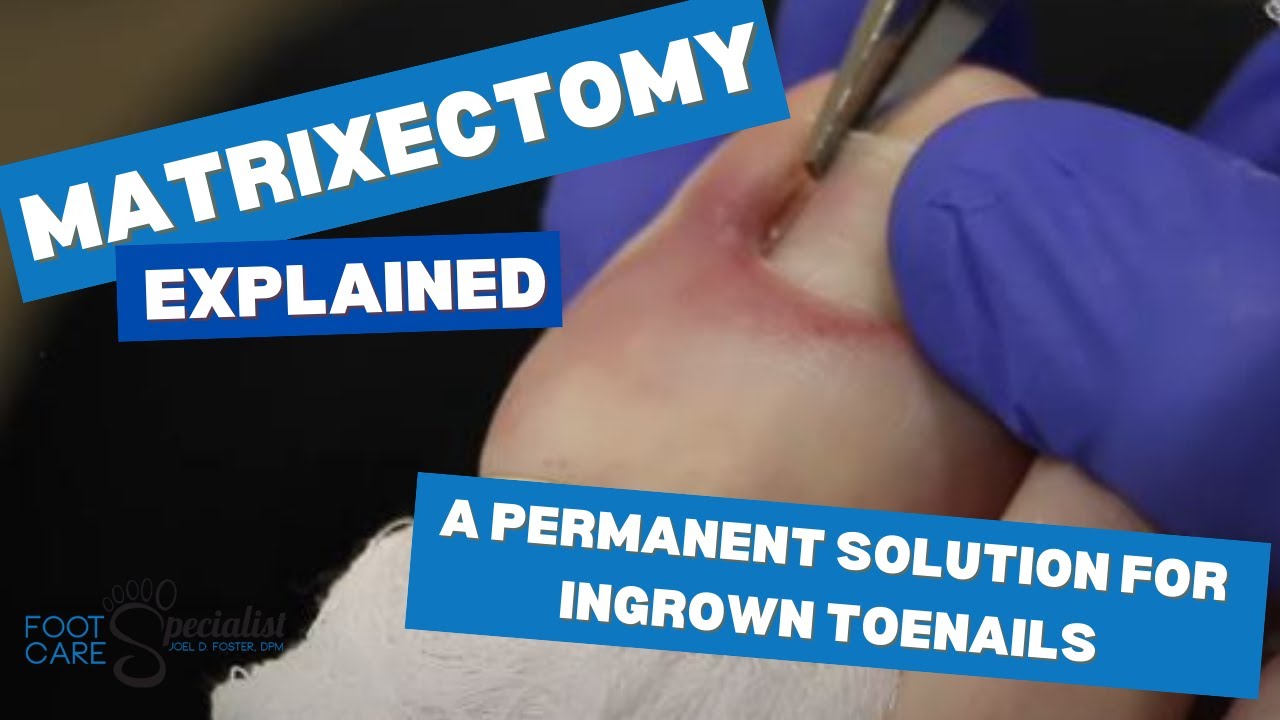 Ingrown Toenail Removal: Matrixectomy Procedure | Kansas City Direct ...