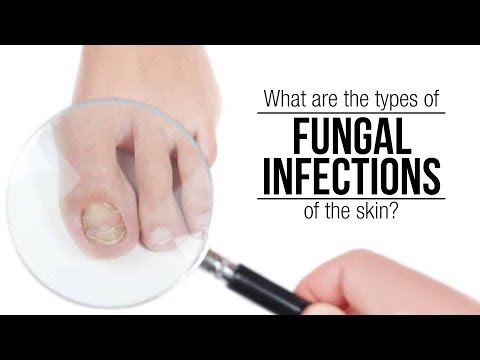 What are the types of fungal infections of the skin? | Treating fungal infection