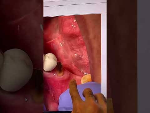 I don’t need no stinking cbct!