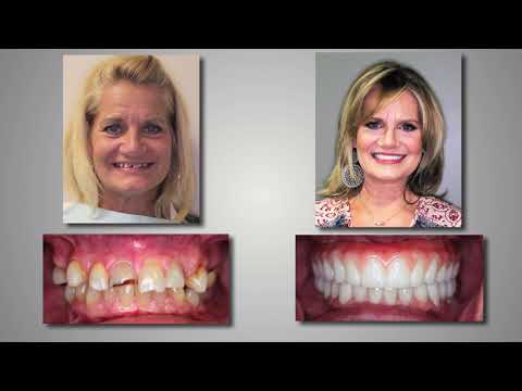 Implants 4 Life - Dr. E's Intro #1 Cut5 03-04-22