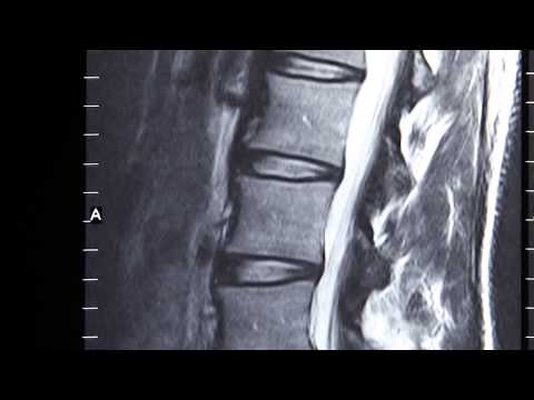 Orthopedic Surgeon Dr. Benjamin Rentfrow - Back Pain