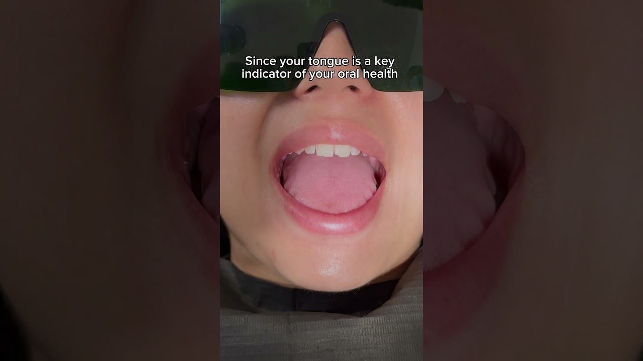 Does your tongue look like this? If so you might have a Scalloped tongue! #tonguehealth