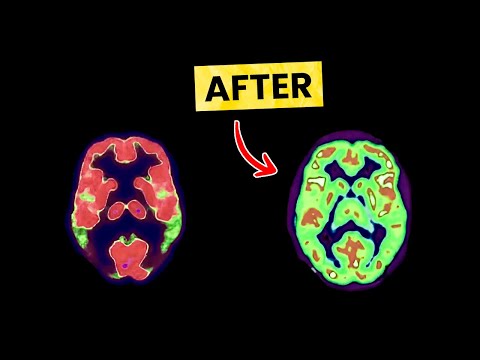 3 Instant ADHD Fixes More Powerful Than Medication