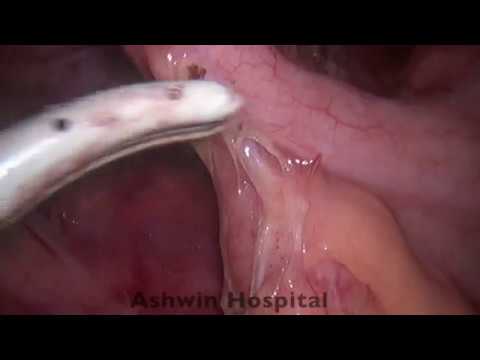 Lap Appendectomy (Retro-caecal)