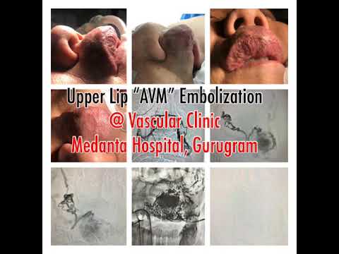 Vascular Malformation Hemangioma AVM etc
