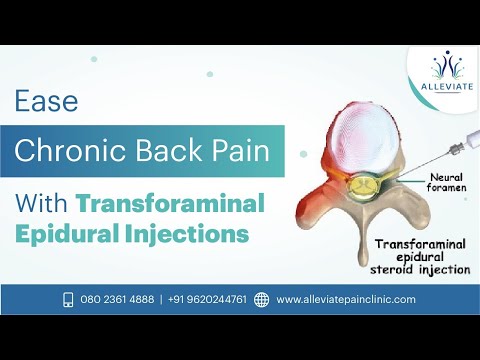 Back Pain Treatment | Pain Management | Transforaminal Epidural Injection