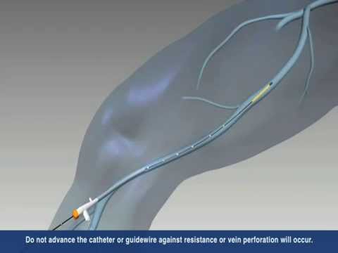 Minimally Invasive Treatment for Venous Insufficiency (CVI) and Varicose Veins in Norfolk, MA 02056