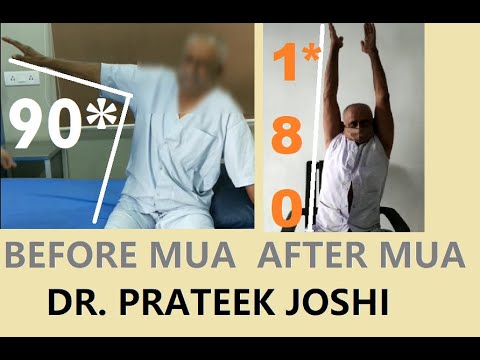 SHOULDER MUA - Manipulation Under Anesthesia | Dr. Prateek Joshi