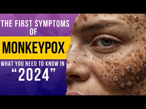 How To Spot The First Symptoms Of Monkeypox