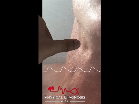 Normal Carotid Pulse (Narrated)