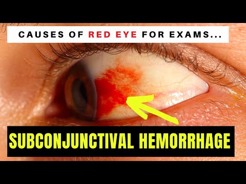 Causes of Red Eye - Part 1: SUBCONJUNCTIVAL HAEMORRHAGE (blood on the eyeball)