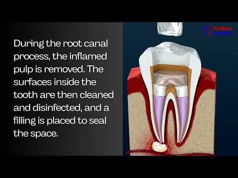 What is Root Canal || GoBest Dentist