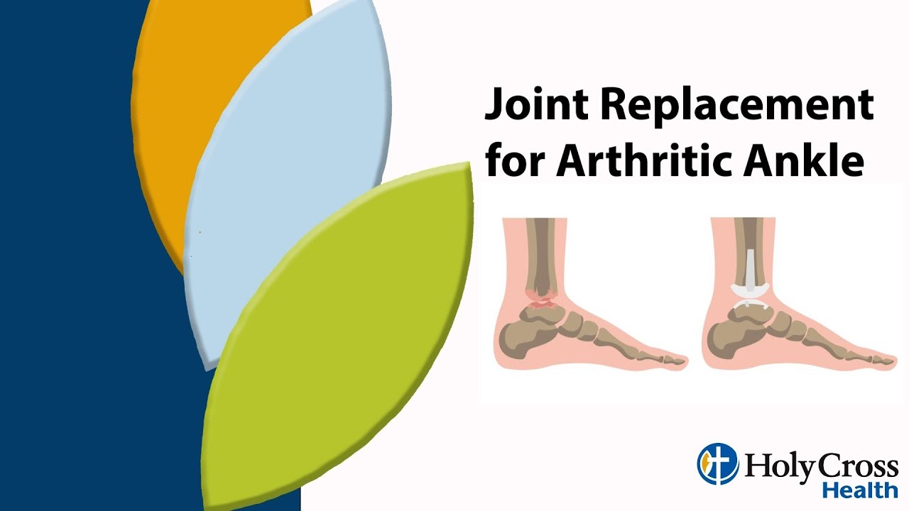 Total Ankle Replacement for Degenerative Arthritis