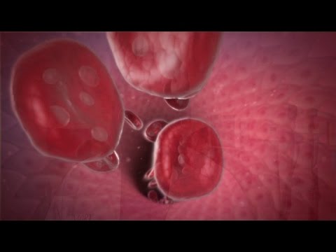 Explaining Anemia