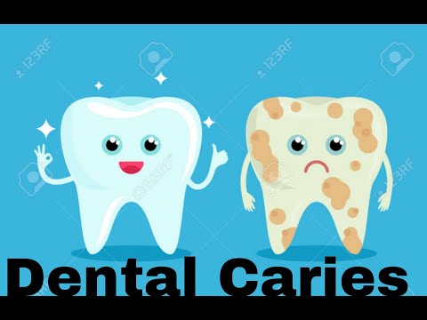 Dental Caries Explained | Dental Exam Preparation in Hindi/Urdu | Definition & Tips