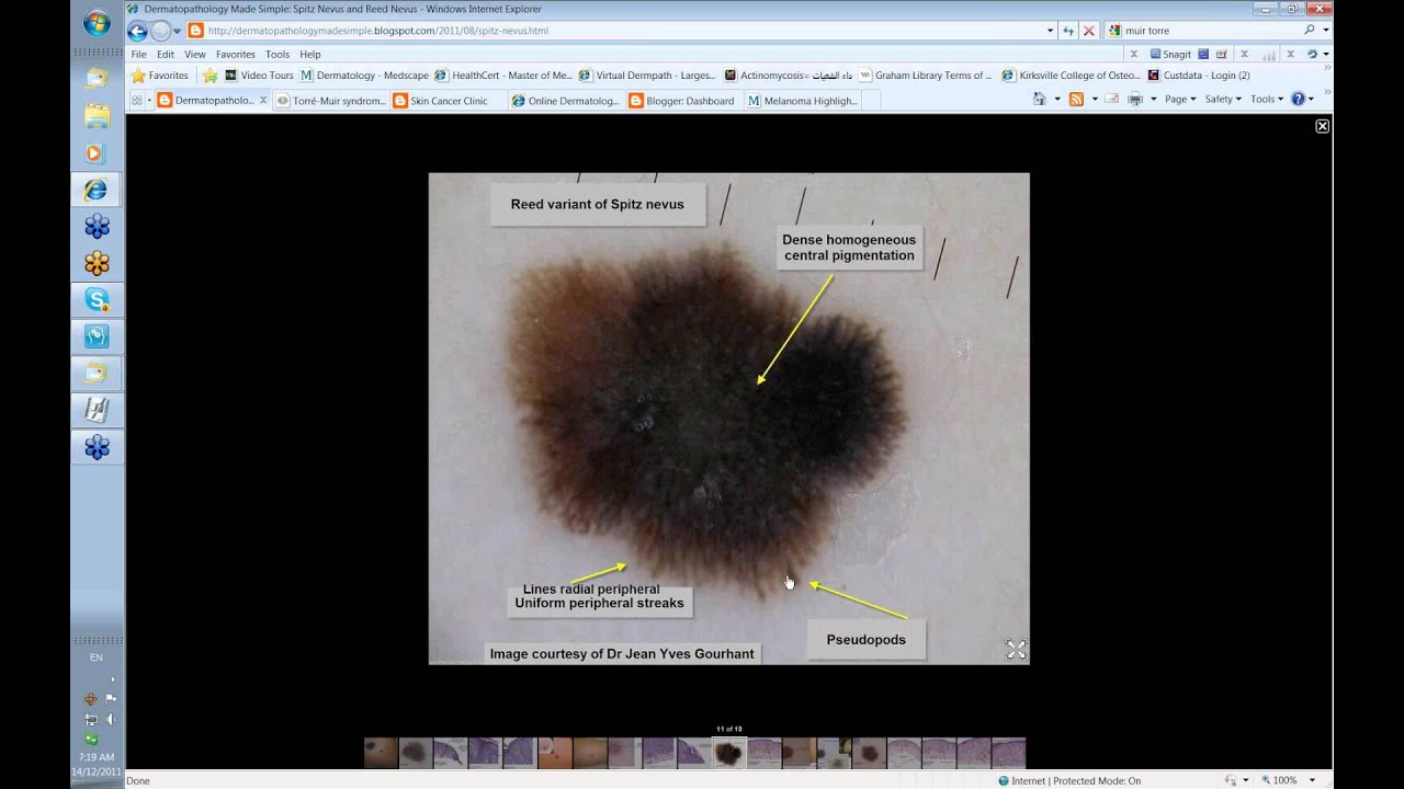 Dermpath Made simple Spitz Reed nevi