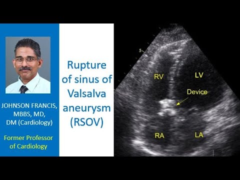 Rupture of sinus of Valsalva aneurysm (RSOV)