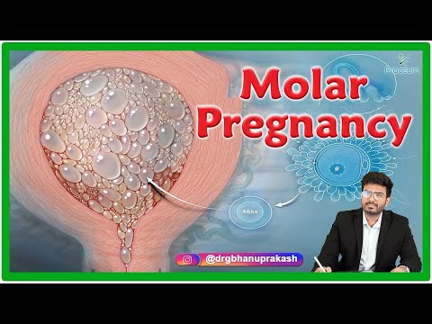 Molar Pregnancy : Causes, Clinical manifestations, Diagnosis, and Treatment
