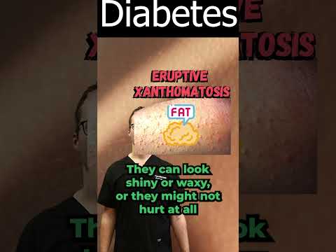 Eruptive Xanthomatosis Pictures & Treatment [Diabetes & Diagnosis]