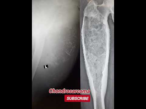 Chondrosarcoma -Malignant disease of older bones - Radiology