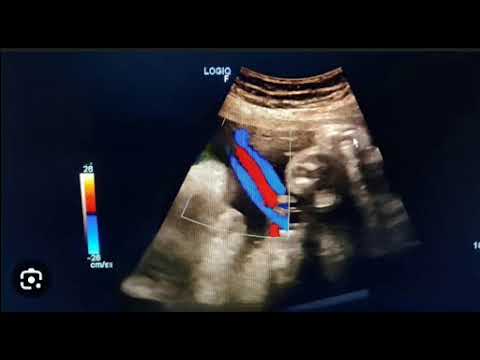 3 vessel cord means boy or girl | 2 vessel cord means ! | The umbilical cord ultrasound in urdu