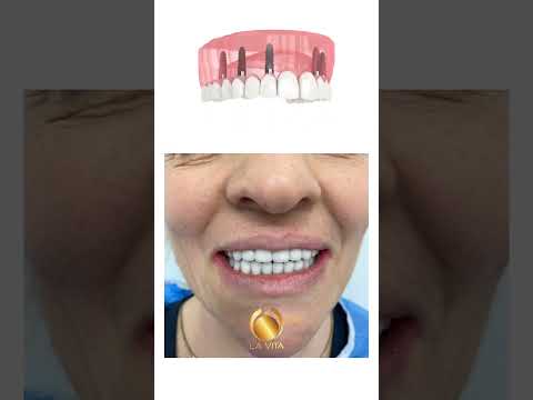 All-on-x dental implants benefits