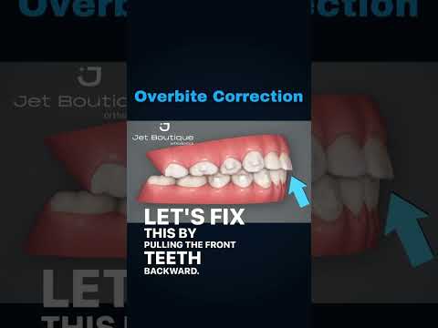 Overbite correction so the front teeth don’t stick out too far.