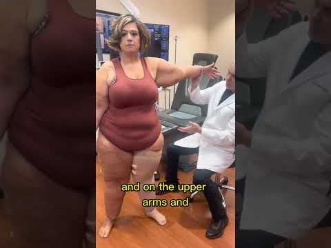 Dr Wright shows the signs of lipedema in the arms