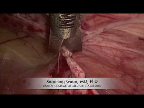 Tips for Successful Laparoscopic Lysis of Adhesions and Enterolysis
